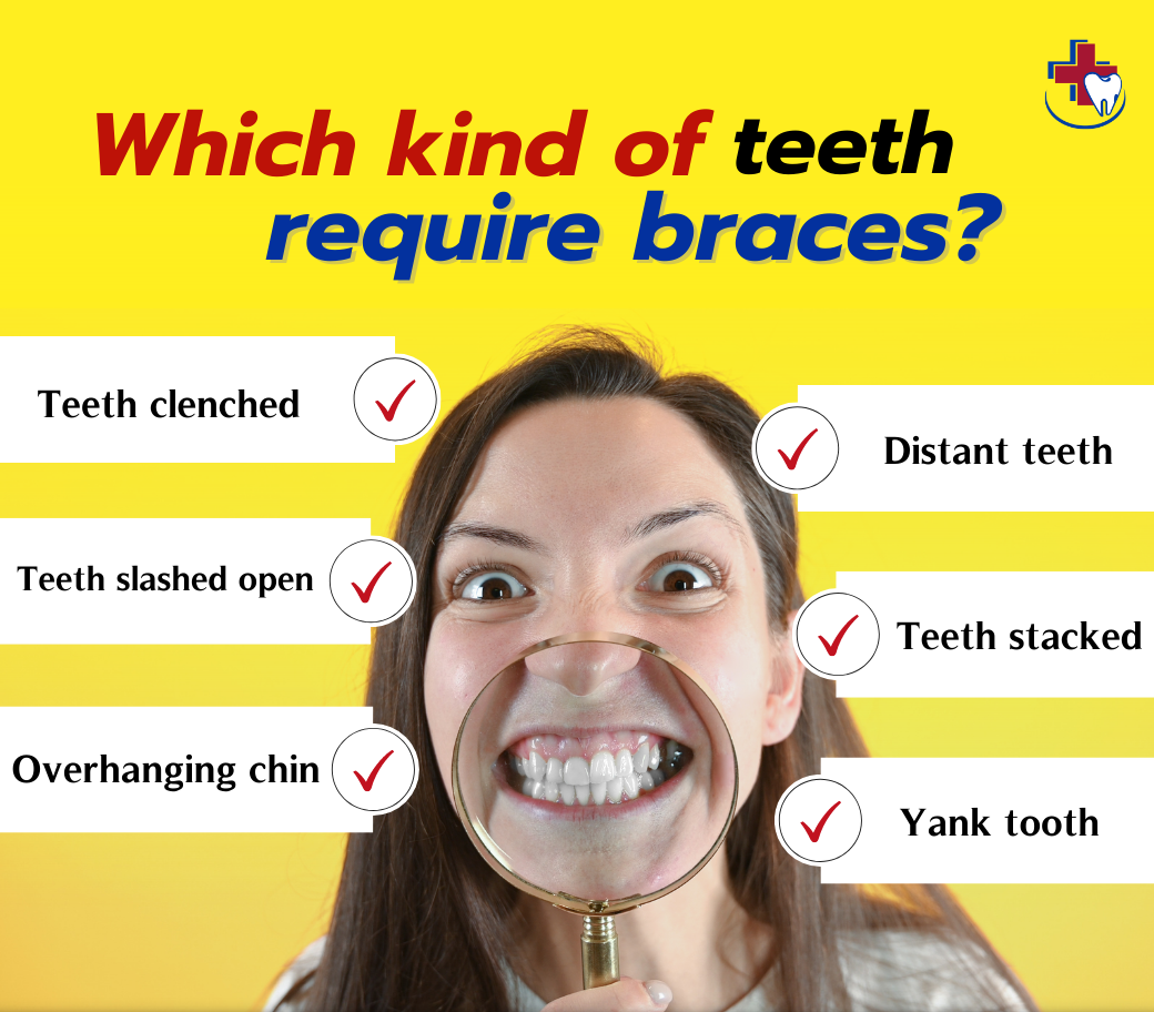 Which kind of teeth require braces? | Chiangmai Hospital | Tel : 053 ...